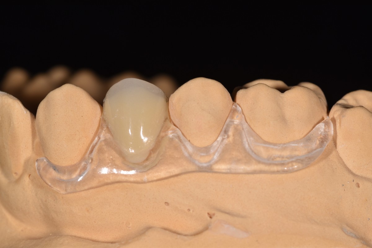 Clearsplint – Die unsichtbare und flexible Alternative im Zahnersatz