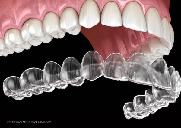 Unsere Schienen: Snap-on und Snap-onAlign - Zahntechnik Mehlhorn